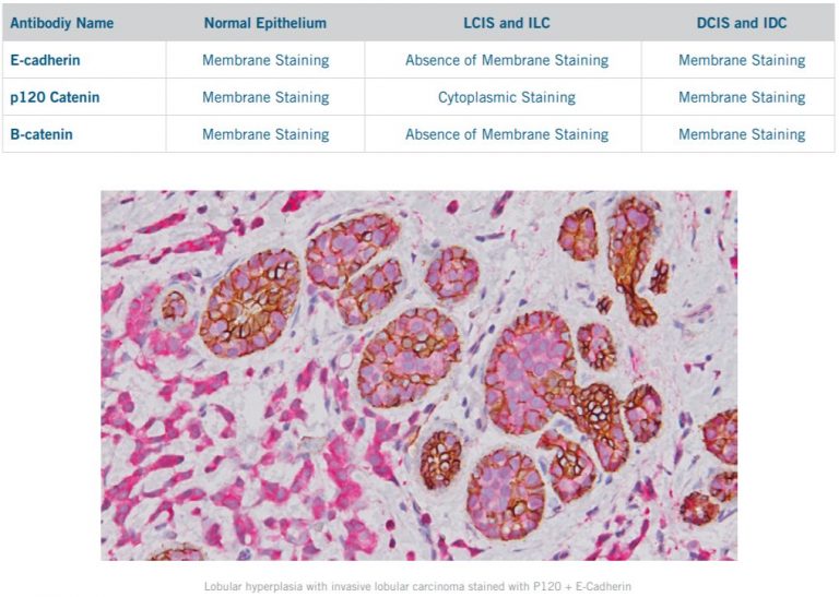 Ductal or Lobular? Narrow your Diagnosis - Biocare Medical
